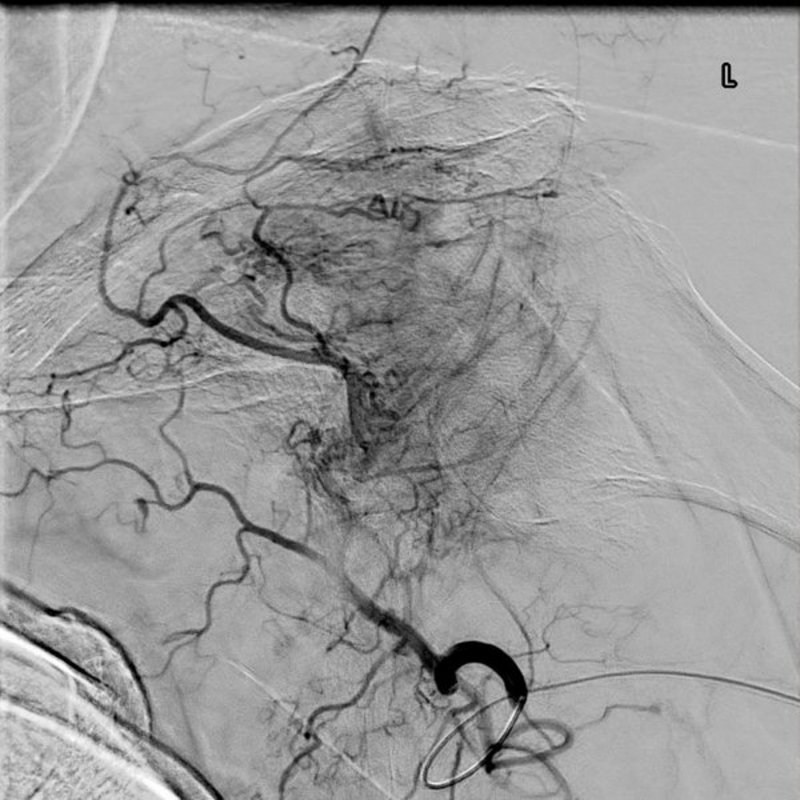 Chronische Gelenkschmerzen – Embolisation | Diagnostische und ...